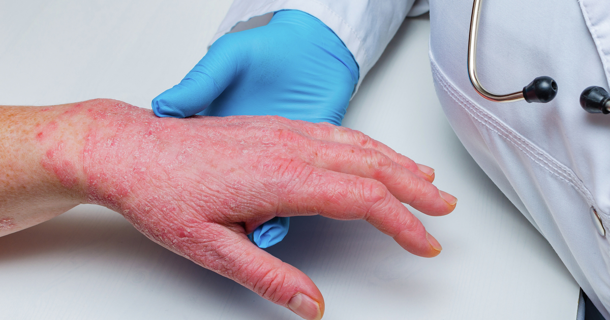 Entstehung von Hautschäden im Beruf | Hautschutz